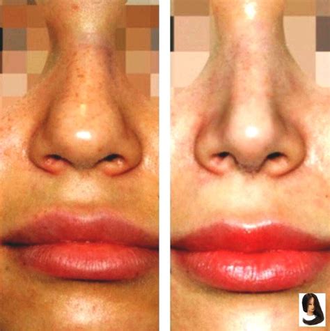 Botox Nose Job Before And After