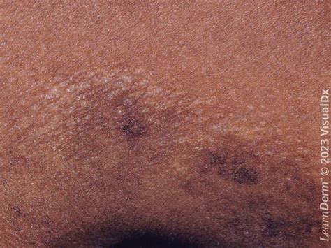 Atrophy Learnderm