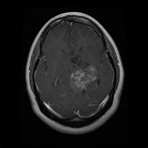 Yolov8 Brt Instance Segmentation Dataset And Pre Trained Model By Final