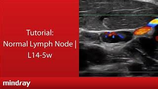Cervical Lymphadenopathy Ultrasound Report
