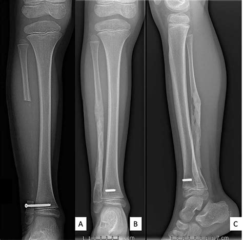 Anteroposterior Radiograph And Lateral View After Right Fibulectomy Download Scientific