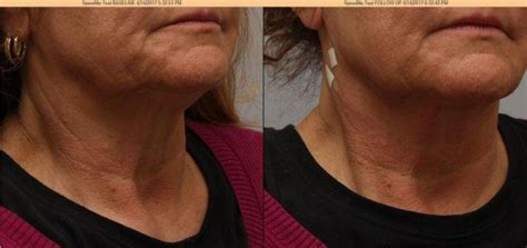 Pdo Threads Expertise Lumier Medical