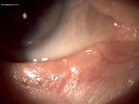 Eyelid Lesions The Importance Of An Early Detection And Treatment