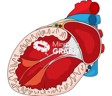 Left Ventricular Remodeling Following Myocardial Infarction 2