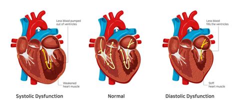 What Are The Symptoms Of Diastolic Dysfunction