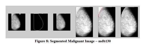 Pectoral Muscle Segmentation In Mammograms Biomedical And