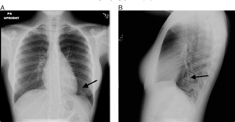 Figure 1 From Embolization Of A Contraceptive Implant Into The