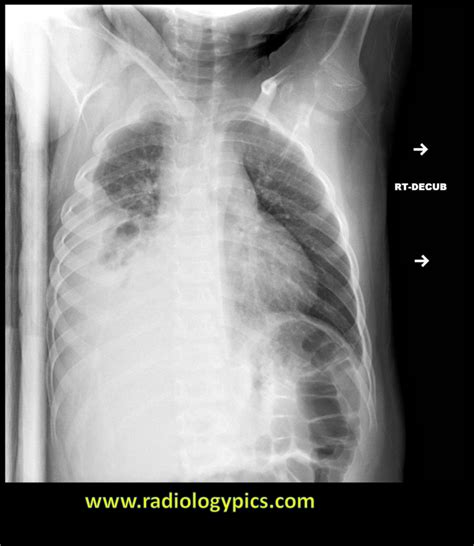 Solution To Unknown Case 23 Empyema Loculated Pleural Effusion