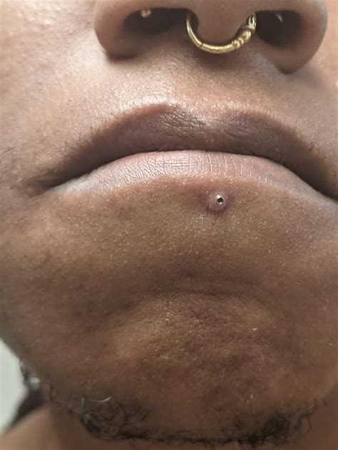 Infection Du Labret Vertical Infection Du Labret Vertical