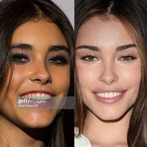 Madison Beer Plastic Surgery Slim Nose With Botox V Shape Chin