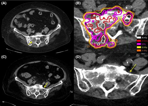 Sacral Insufficiency Fracture After Stereotactic Body Radiation Therapy