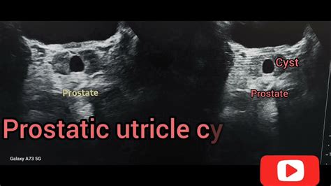 Prostatic Utricle Cyst Youtube