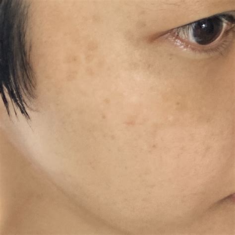 루비레이저 한달 후기 끔찍한 색소침착이 올라왔다 피코토닝으로 변경 효과 부작용 관리 루비 레이저 가격 루비 토닝 루비 피코 레이저