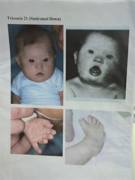 Genetics Syndromes Pdf