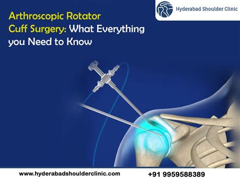 Arthroscopic Rotator Cuff Surgery Youtube At Aaron Smith Blog