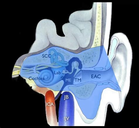 Temporal Bone Resection Temporal Bone Resection