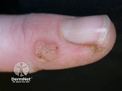 Warts Verrucas Human Papillomavirus Infection