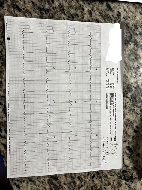 Nervous About My Ekg Help R Askcardiology