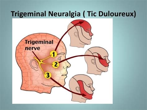 Cranial Nerve Disorders Bells Palsy Facial Paralysis Trigeminal