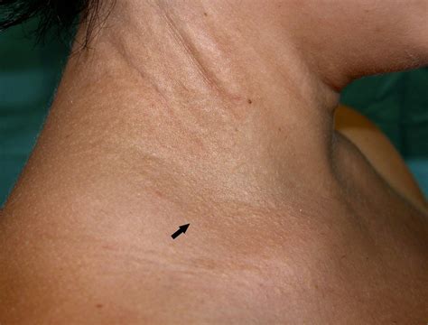 Pseudoxanthoma Elasticum Causes Symptoms Treatment Prognosis And Pictures