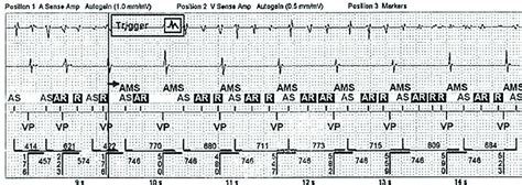 Subclinical Atrial Fibrillation Detected By An Implantable Pacemaker Download Scientific Diagram