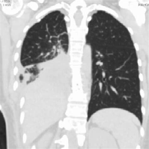 control ct scan that shows lung parenchyma window 10 days after