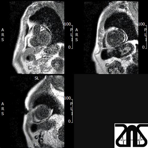 Cardiovascular In The First Pass Perfusion Imagesthere Is Large Transmural Hypoperfusion In All