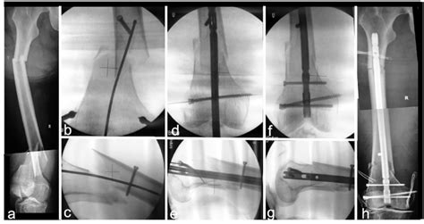 A Segmental Closed Fracture Of The Right Femur In A 33 Year Old Download Scientific Diagram