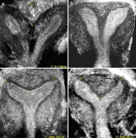 Congenital Uterine Anomalies Radiology Key