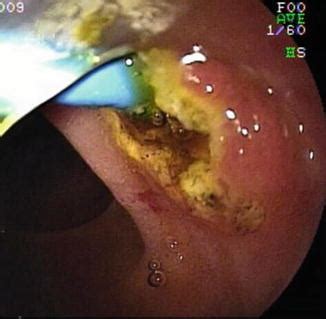 ERCP In Patients With Altered Anatomy Abdominal Key