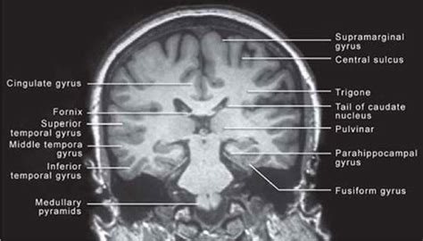 Fusiform Gyrus Coronal