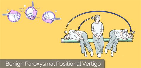 Benign Paroxysmal Positional Vertigo Bppv Best Treatments