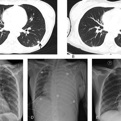 Lung Computed Tomography Ct Images And Chest Radiographs Of The Download Scientific Diagram