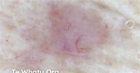Basal Cell Carcinoma Image