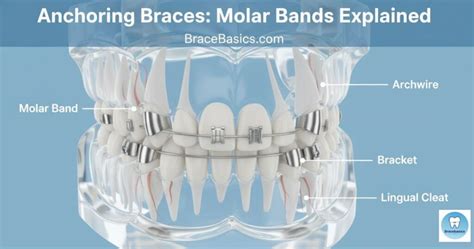 Parts Of Braces 10 Powerful Components You Must Know For A Perfect