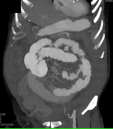 Infectious Enterocolitis Small Bowel Radiology Case Studies Ctisus