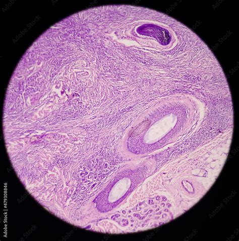 Tissue From Scalp Tumors Of Skin Microscopic Image Of A Dermatofibroma Benign Tumor Show