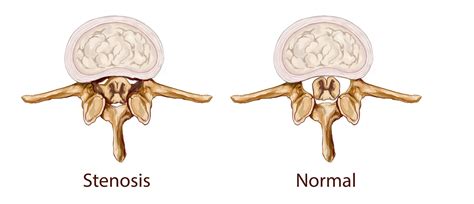 Spinal Stenosis Endospine Hellas