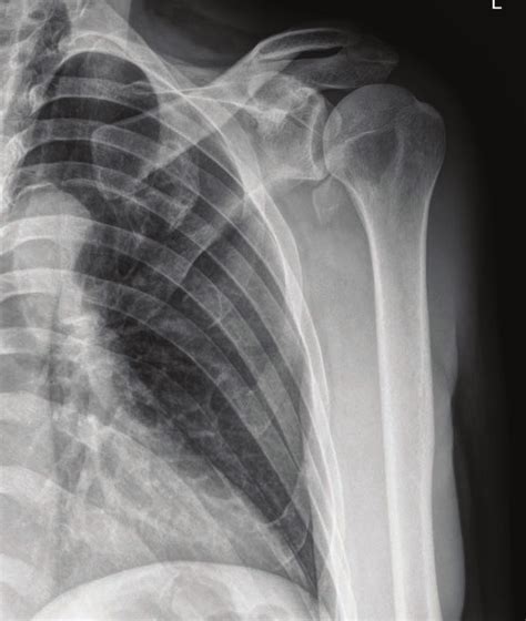 Anteroposterior Radiograph Of The Left Shoulder Shows The Displaced