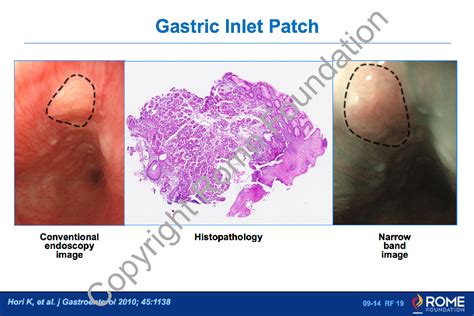 Esophagus 10 Dilated Intercellular Spaces Rome Online