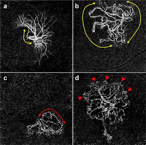 Morphologic Patterns Of Choroidal Neovascularization Cnv On Optical Download Scientific