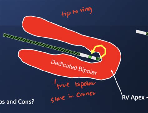 Icd System Flashcards Quizlet