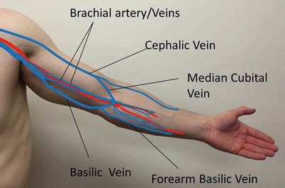 Brachiobasilic Arteriovenous Fistula Springerlink