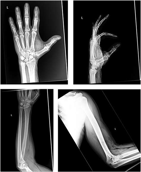 Xray Arm