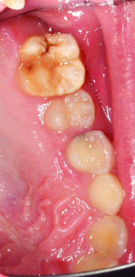Hypominezalized Upper Molar With Posteruptive Fracture Download