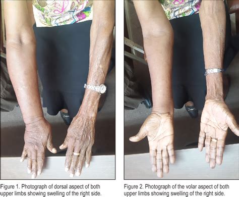 Lymphedema Upper Arm
