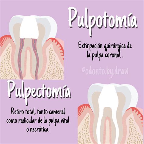 Pulpotomía Y Pulpectomía Odontologia Pediatrica Anestesia En