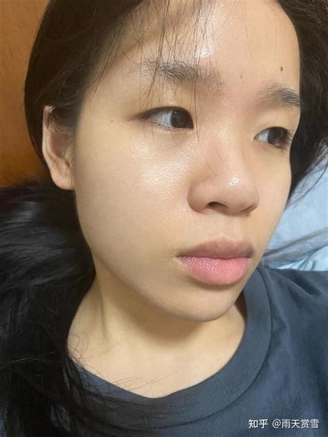 脸上长痘痘怎么办刷酸管用吗水杨酸乳糖酸果酸壬二酸哪种最有用 知乎