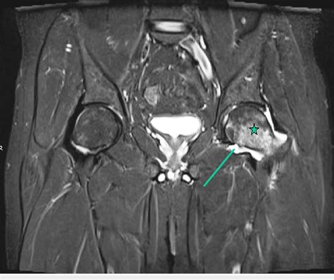 This Is A Fluid Sensitive Image Stir Sequence Showing Left Hip Joint Download Scientific