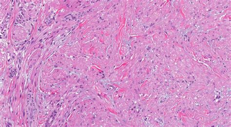 Leiomyoma Of The Skin Ottawa Atlas Of Pathology